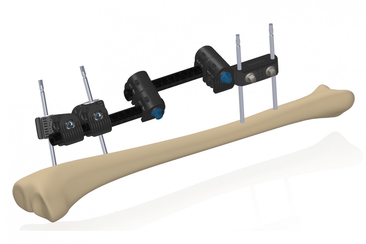 Fixateurs externes Archives - JPP Management